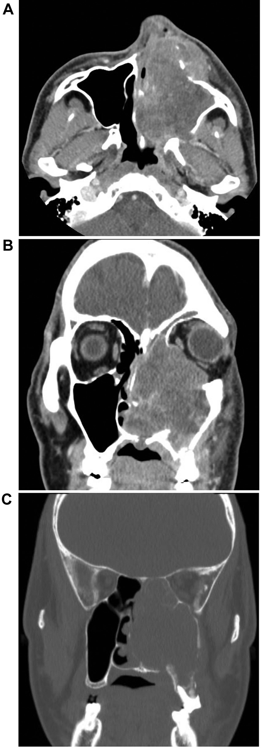 Sinus Cancer Test