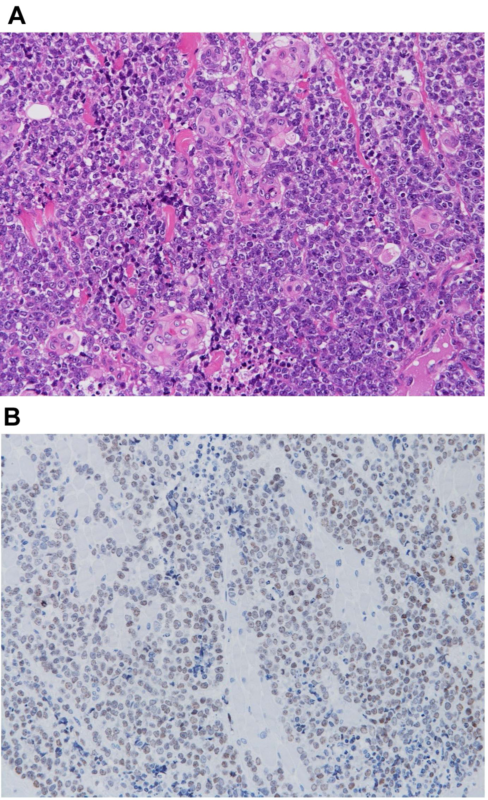 Cancer Diagnosis & Prognosis